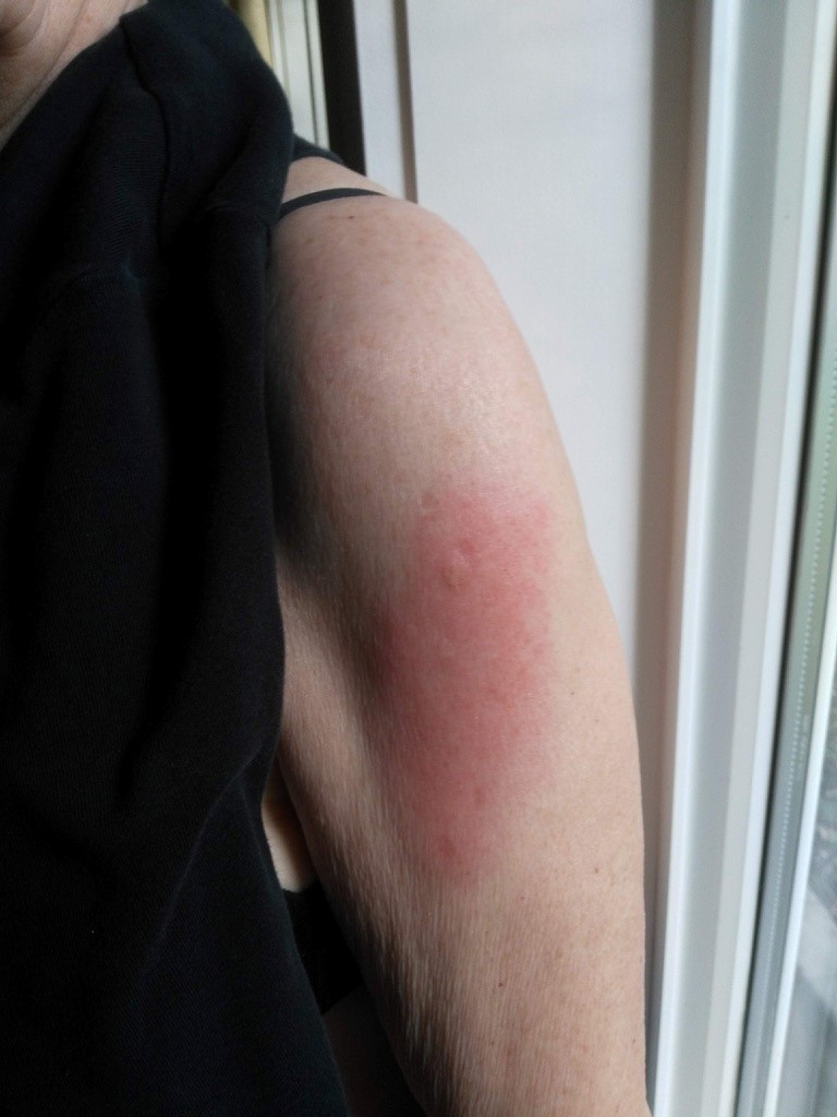 COVID Arm Skin Reactions At Injection Site Of Moderna Vaccine In BC COVID Arm Skin Reactions At Injection Site Of Moderna Vaccine In BC